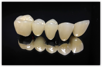 Porcelain Fused to Metal (PFM) | Treasure Dental Lab | Boise, Eagle ...