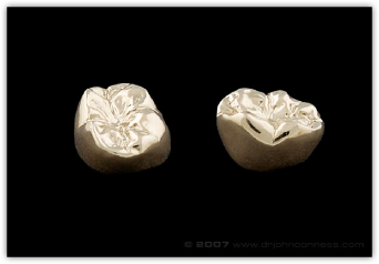 Full Cast Crowns | Treasure Dental Lab | Boise, Eagle, Meridian