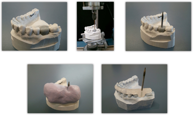 Dental Implant Stents | Treasure Dental Lab | Boise, Eagle, Meridian