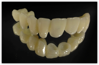 PMMA Temporaries | Treasure Dental Lab | Boise, Eagle, Meridian